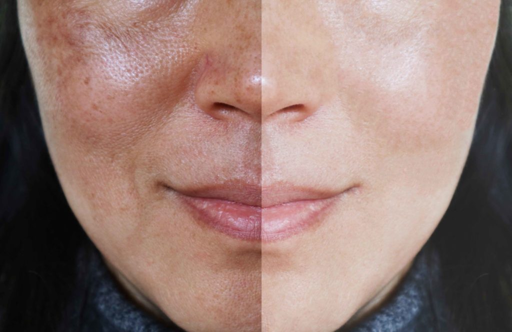 Pore Shrinking | Newport & South Kingstown RI.